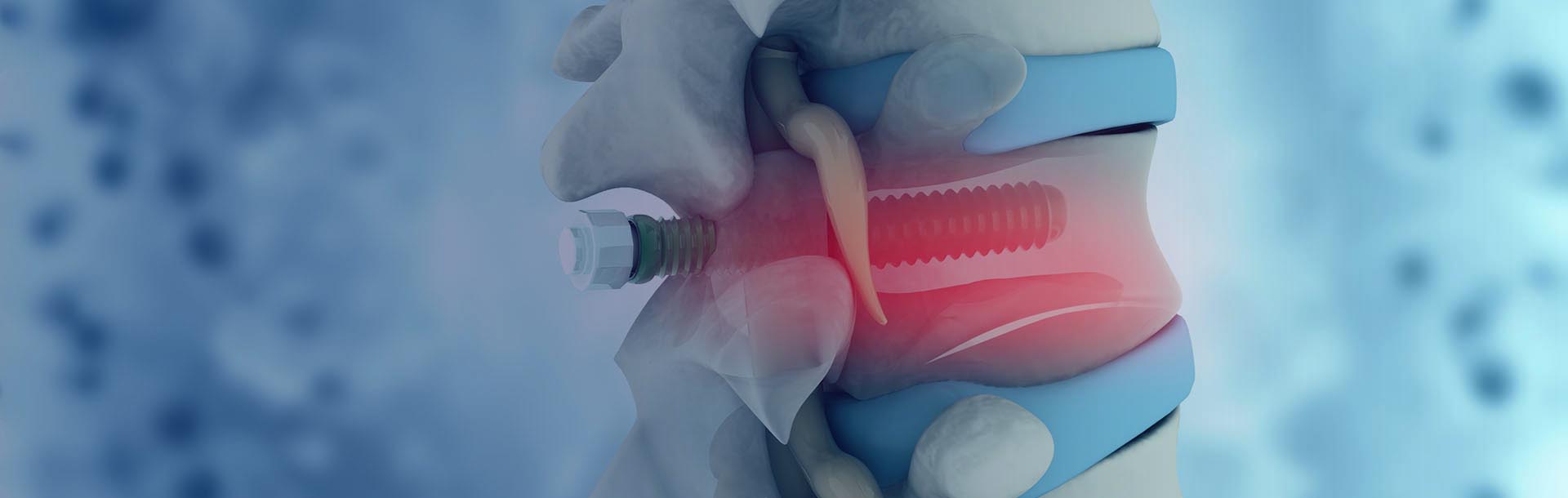 Medical implant manufacturing and control - Sensofar